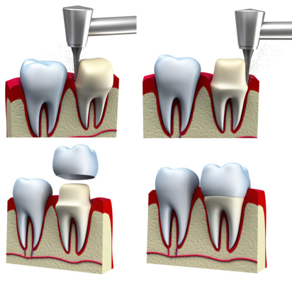 Dental crown installation process, isolated on white - Fivecorner